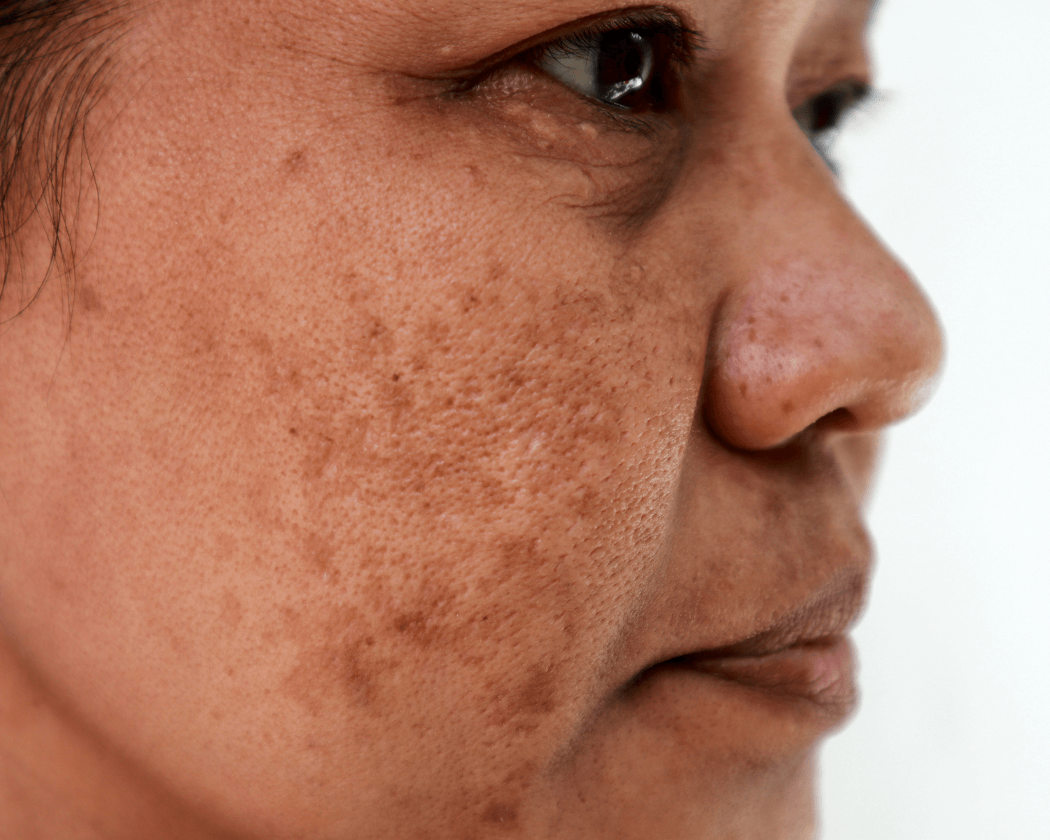 Irregular Pigmentation | Dermatology Central Iowa