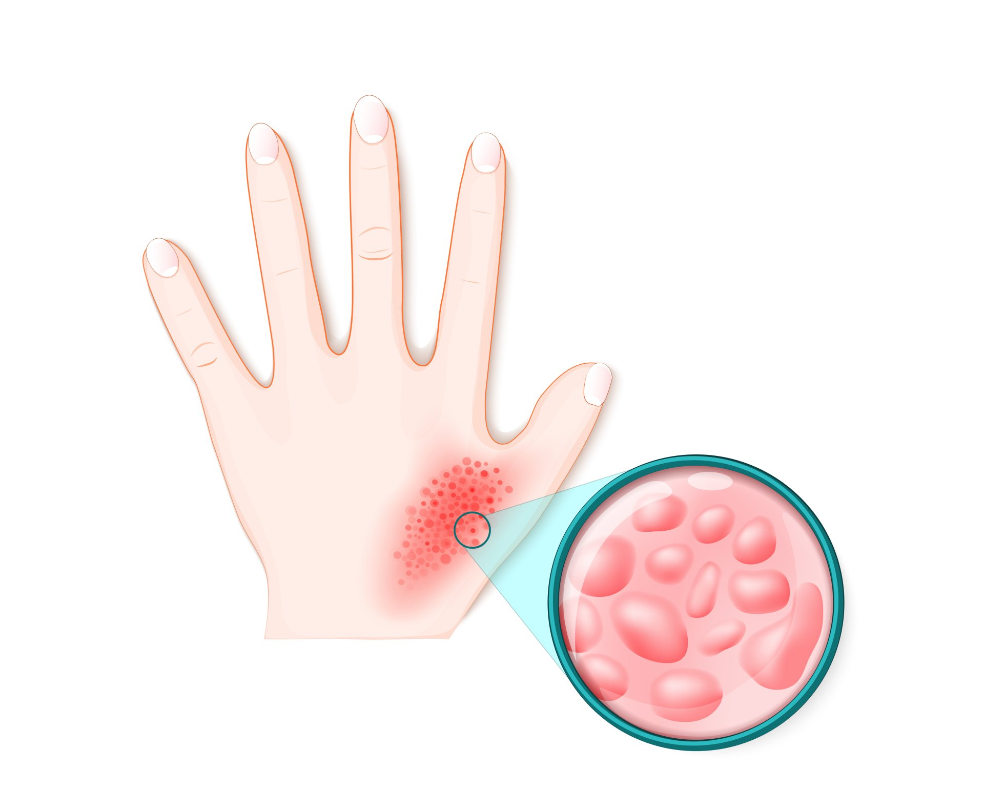 Hives | Dermatology Central Iowa