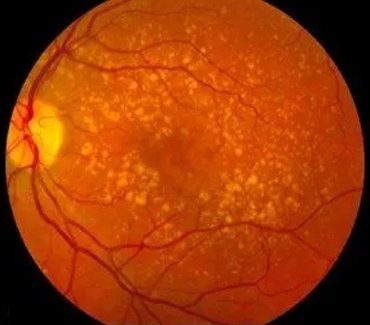 Eye Health - Hansen Optometrists - Eyecare Plus