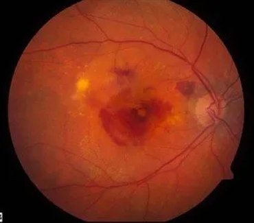 Eye Health - Hansen Optometrists - Eyecare Plus