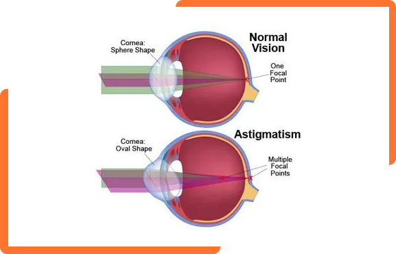 Eye Health - Hansen Optometrists - Eyecare Plus