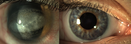 Cosmetic & Prosthetic Contact Lenses | West Chester, OH