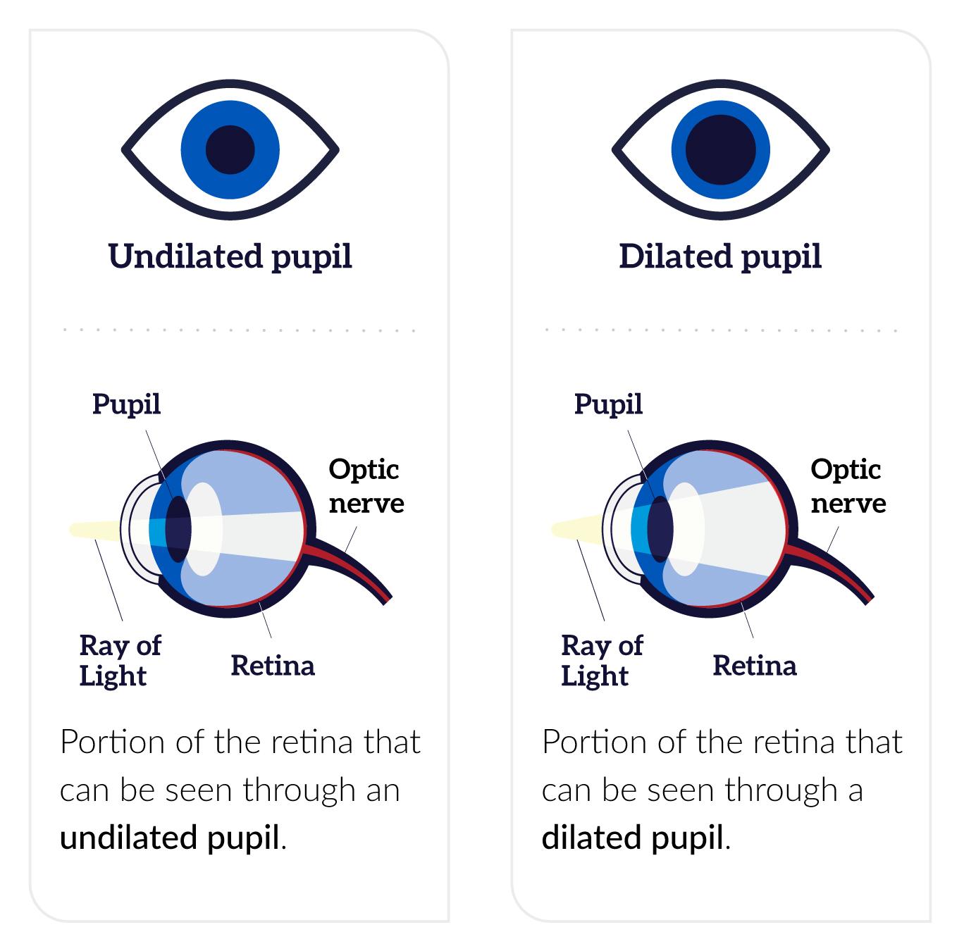 Fixed And Dilated Pupils Meaning – UQJFK