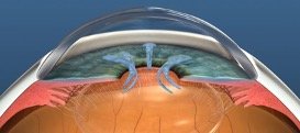 The importance of checking intraocular pressures