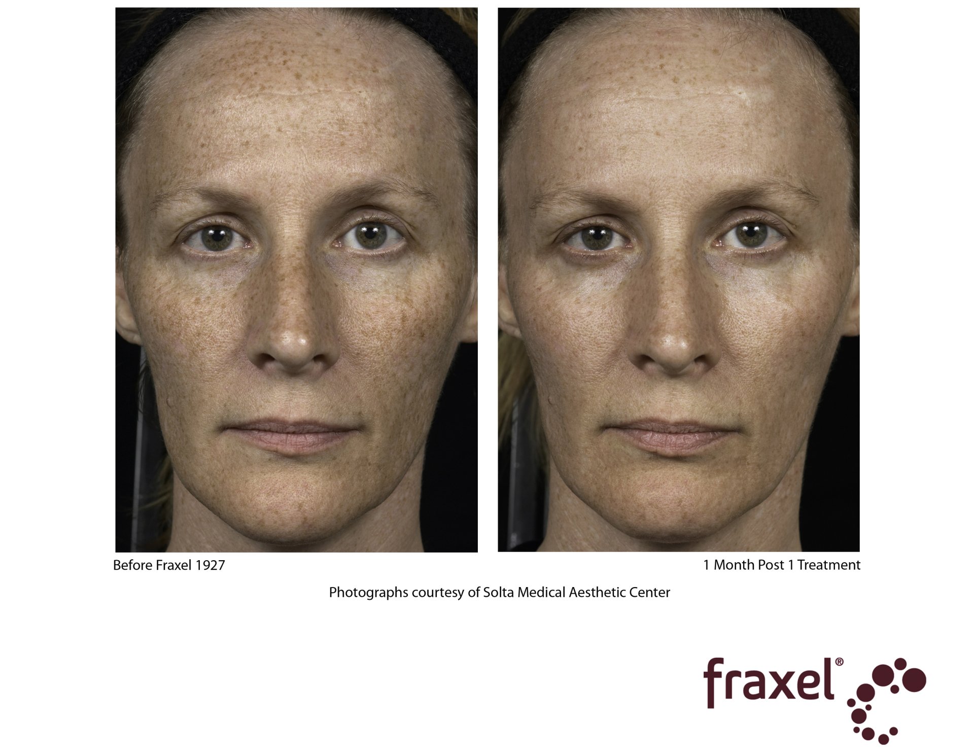 California Coastal Dermatology | Fraxel®