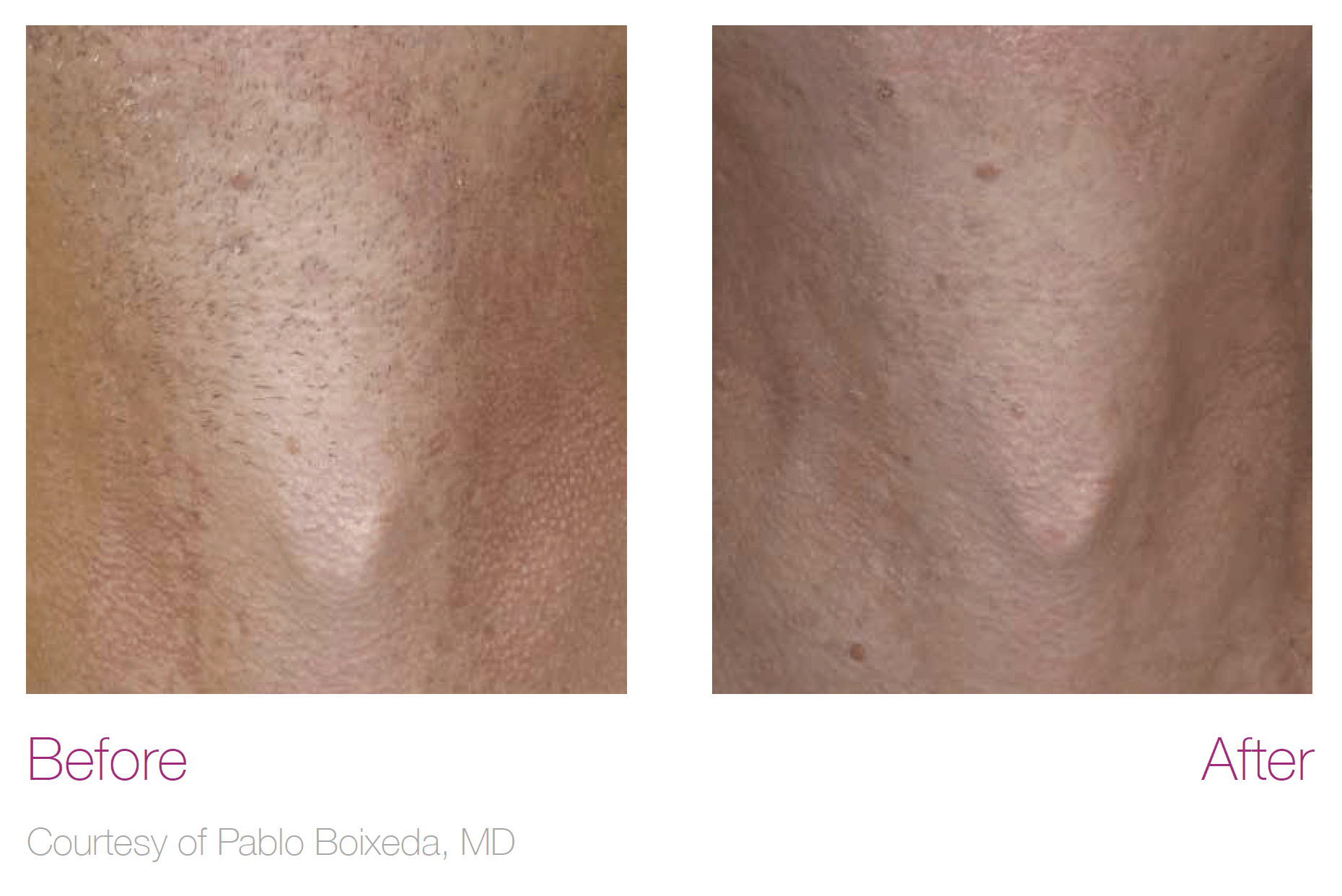 California Coastal Dermatology | Nordlys™ Laser