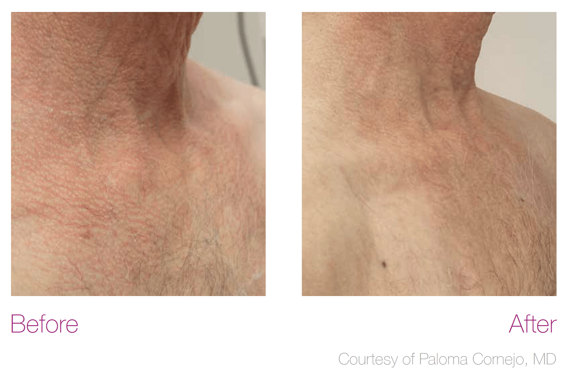California Coastal Dermatology | Nordlys™ Laser