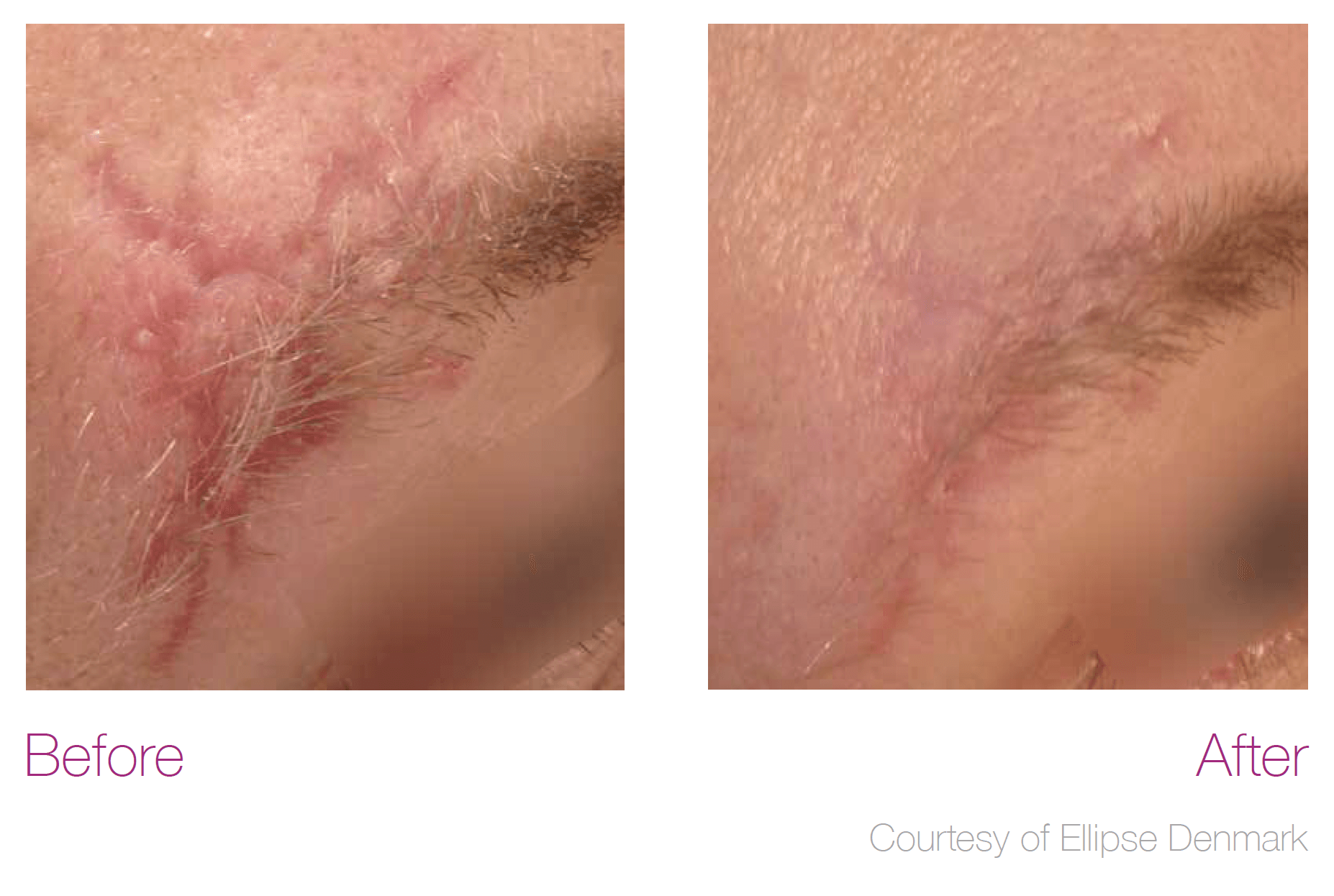 California Coastal Dermatology | Nordlys™ Laser