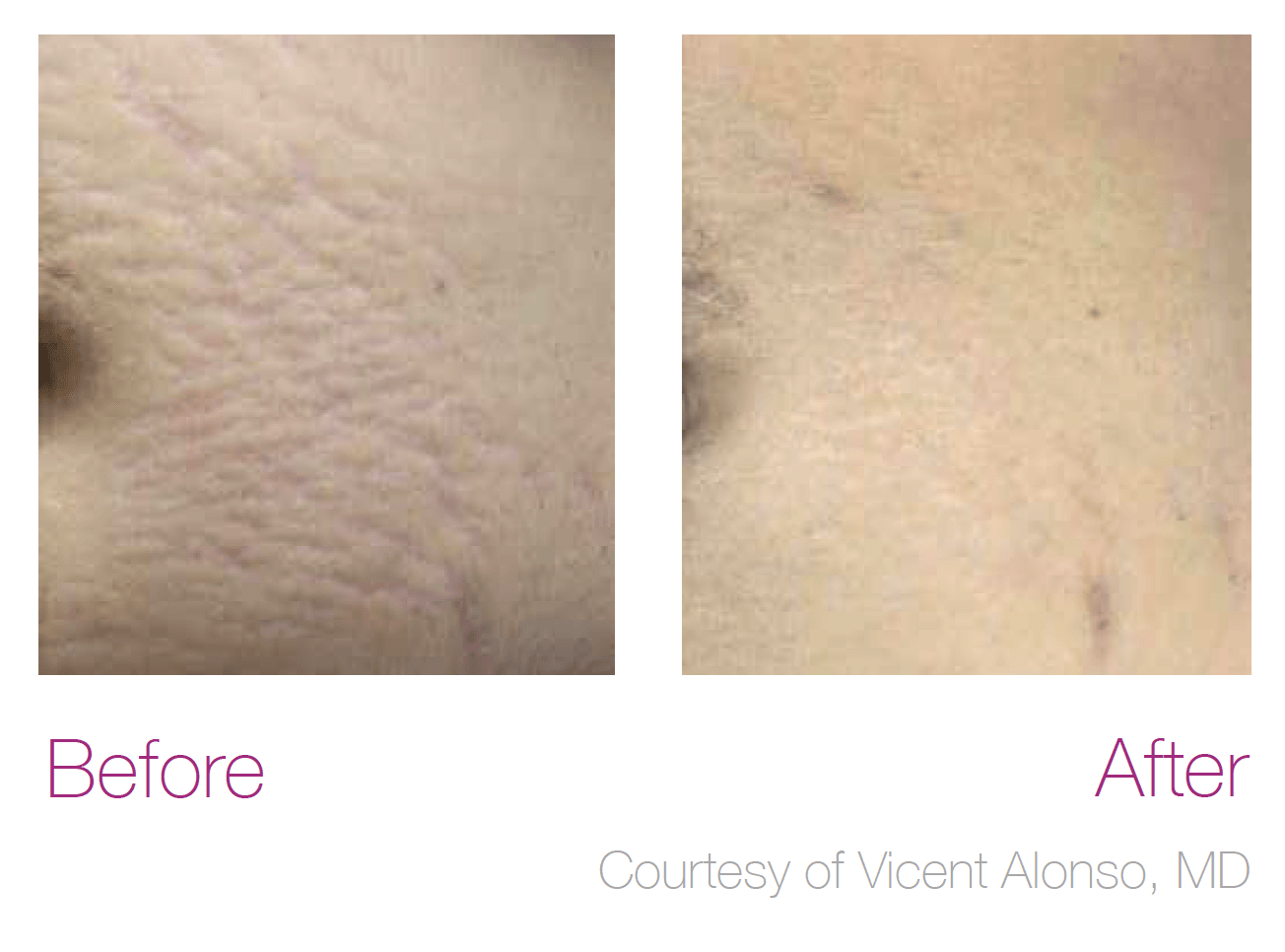 California Coastal Dermatology | Nordlys™ Laser
