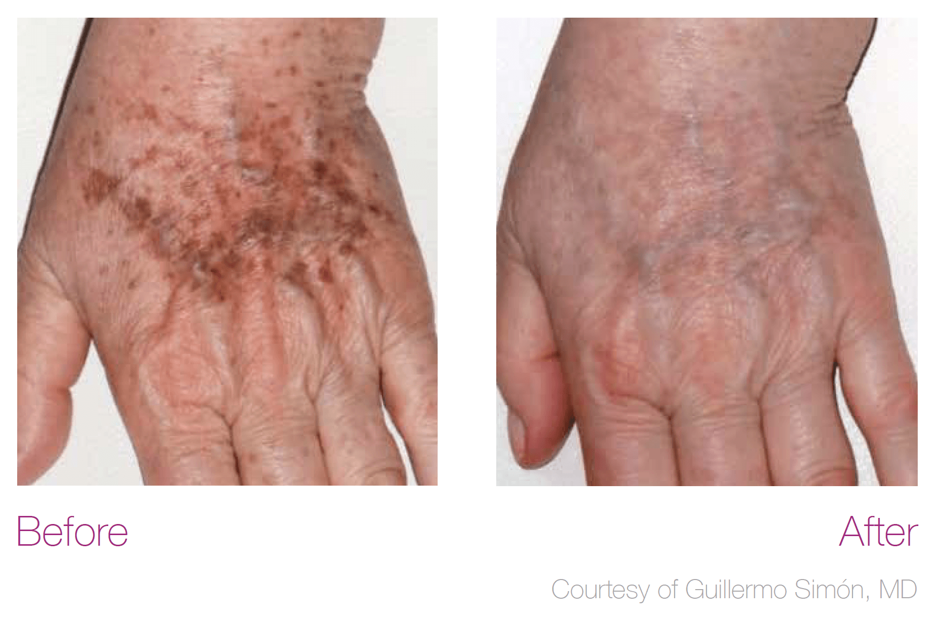 California Coastal Dermatology | Nordlys™ Laser