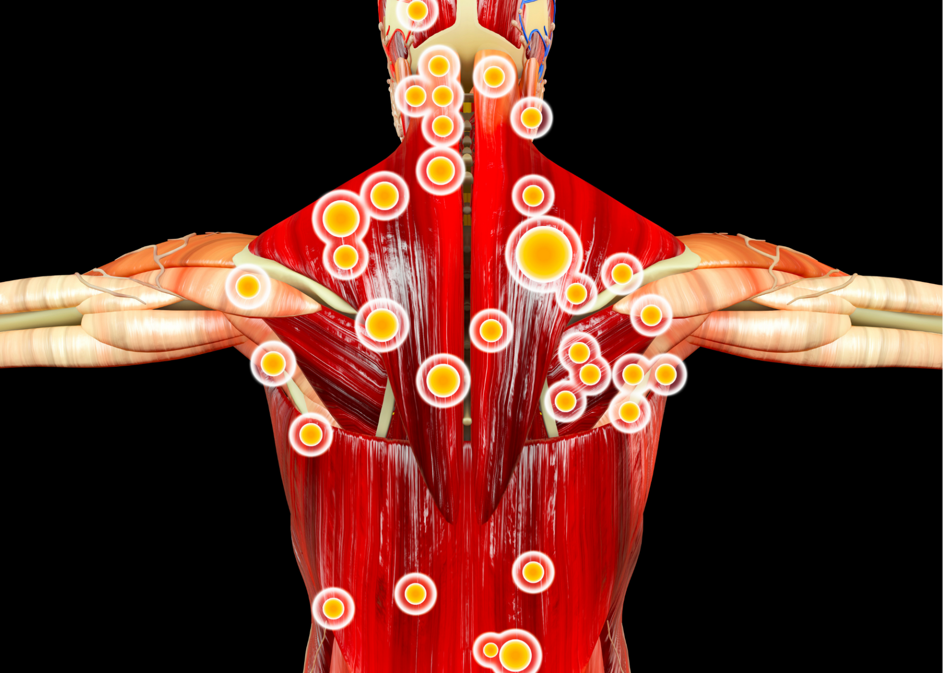 Troublesome Trigger Points