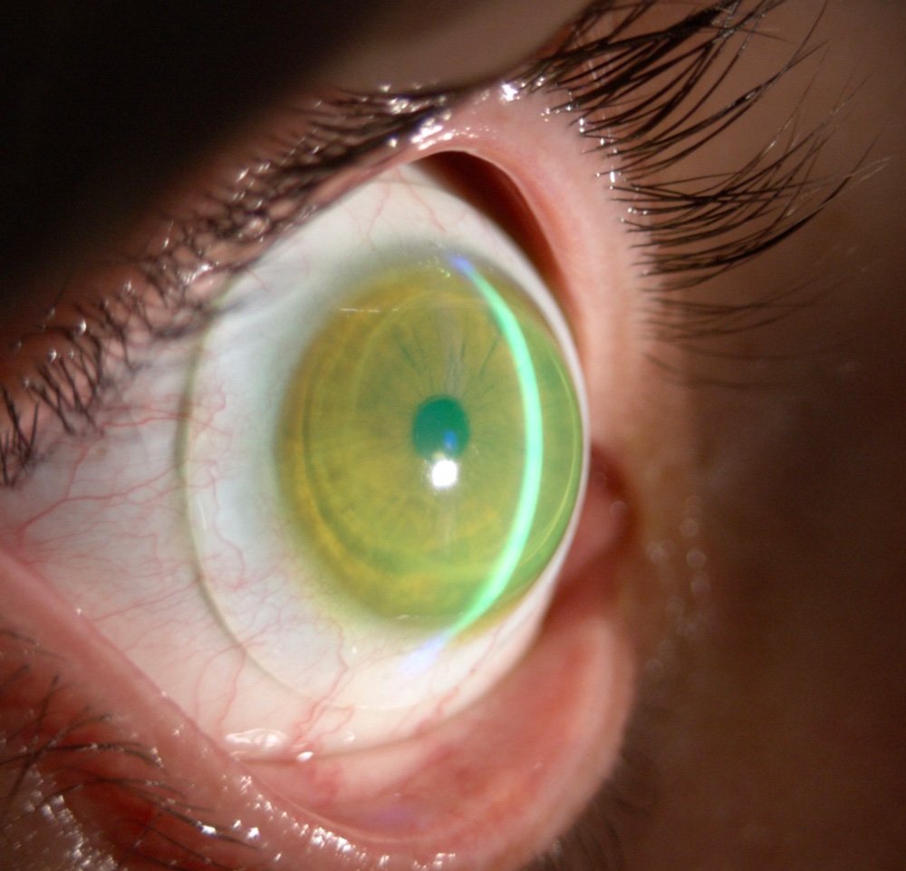 Contattologia Specialistica | Ceprano, Cassino FR | Ottica Pontarelli ...