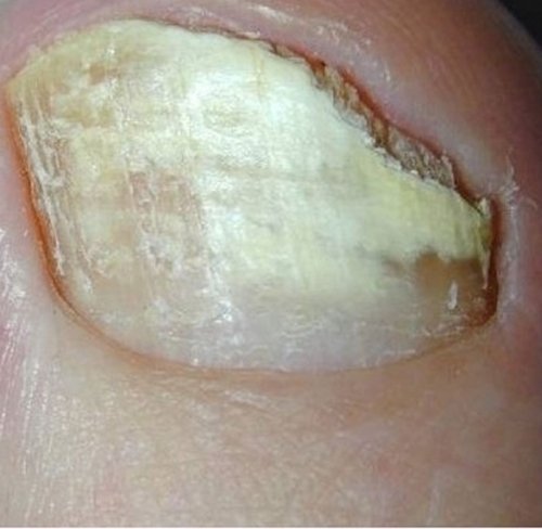 Funghi dell'alluce| Fiumicino | Bartolucci Dott.ssa Fiorella Podologa