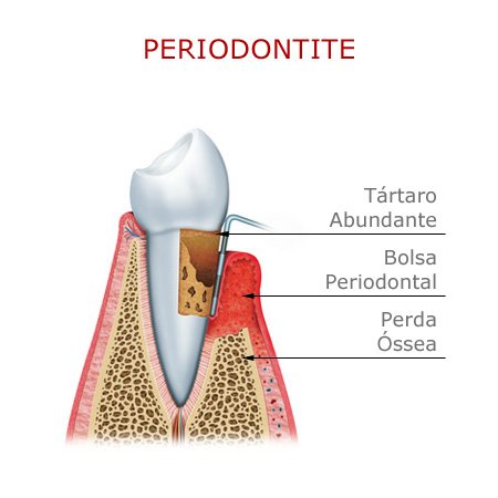 Periodontia em Santos | Dr. Wilson Thadeu Canaan