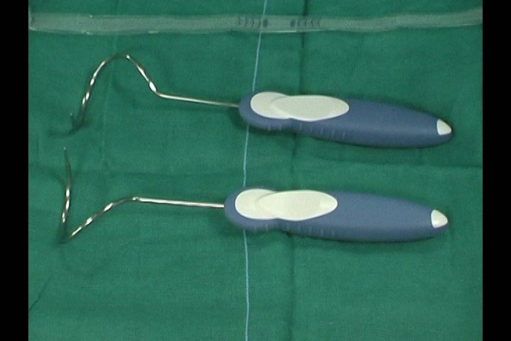 INCONTINENZA FEMMINILE