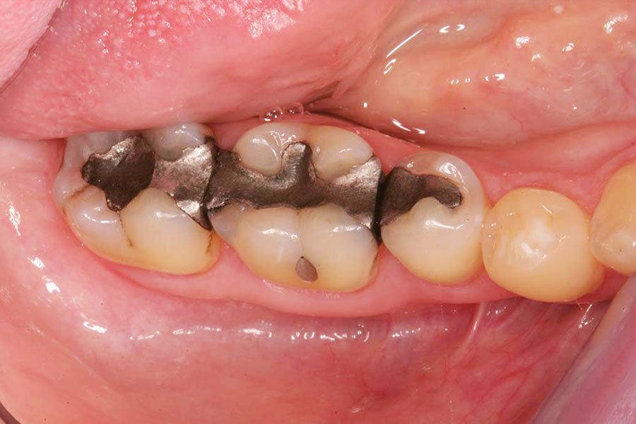 Tooth-Colored Fillings in Lunenburg, MA - David D Gianino, DDS