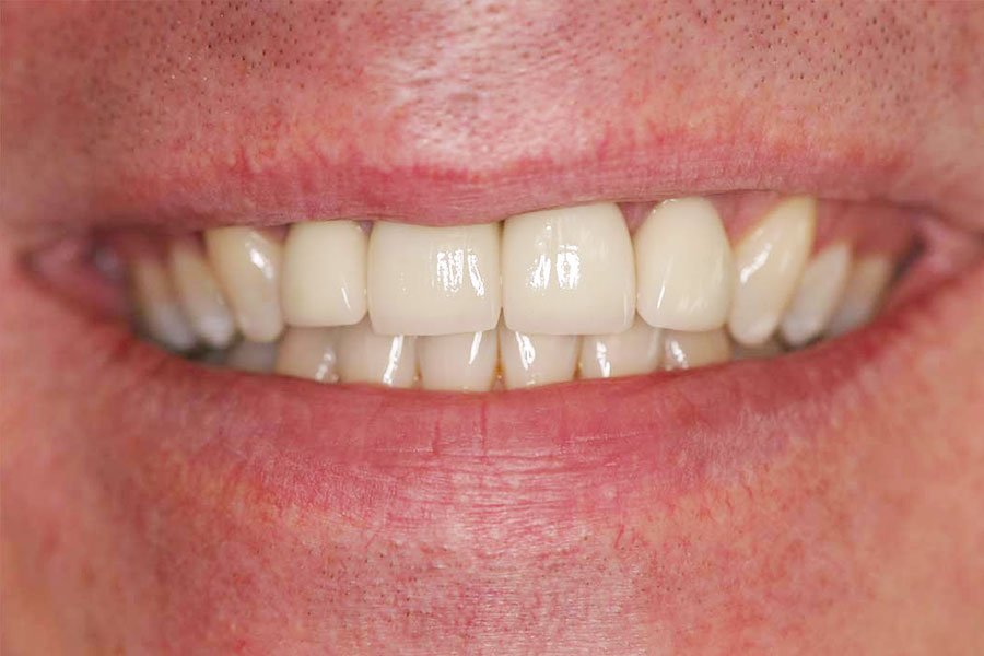 Dental Bridges in Lunenburg, MA - David D Gianino, DDS