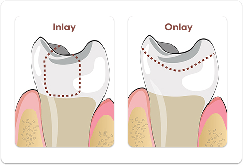 Inlays and Onlays, Newark and Bear Dentist