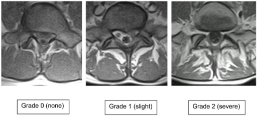 What is the MedX Lumbar Extension Machine?