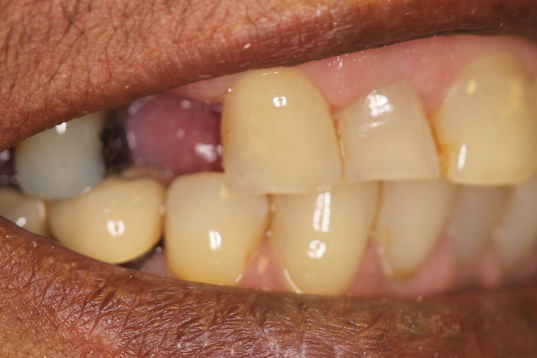 Our Before & After Smile Gallery | Pall Mall Dental