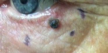 Mohs Surgery Case - Basal Cell Carcinoma on Eyelid & Discussion on Eye ...