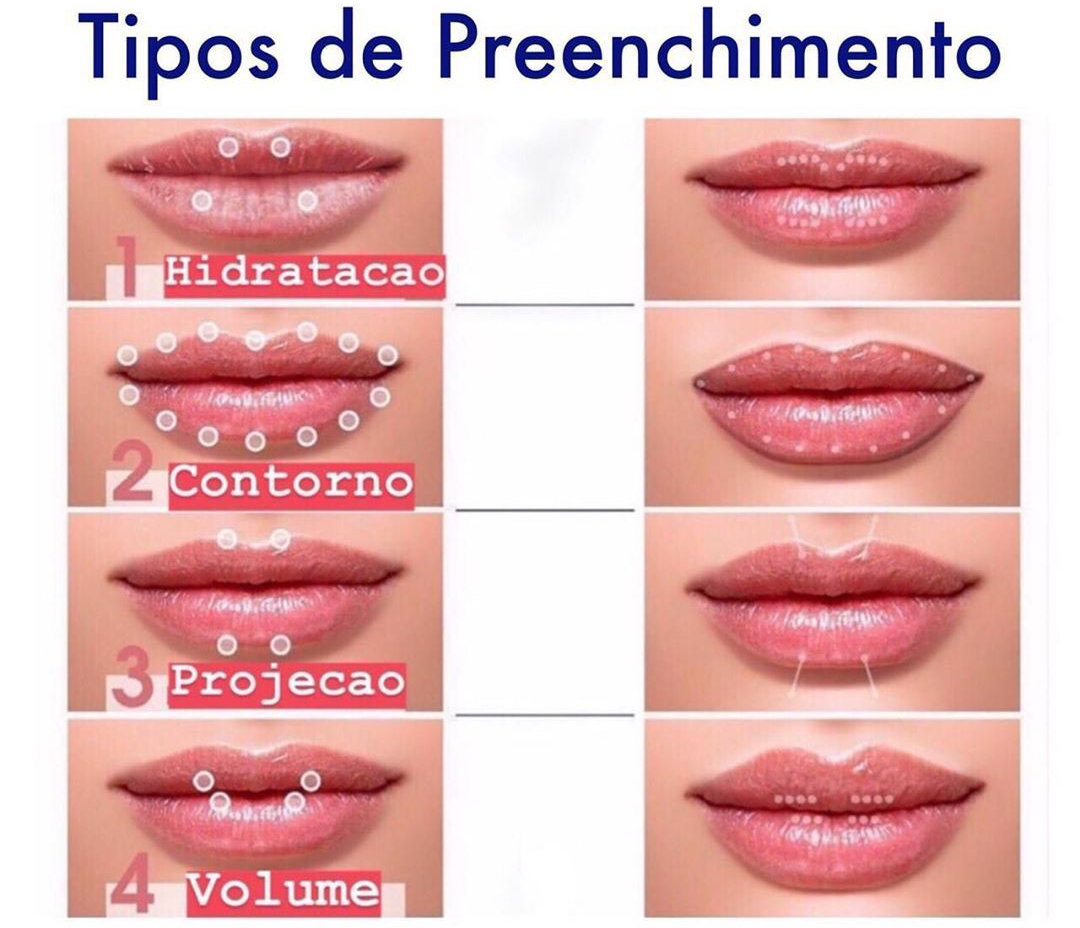 Relleno de Labios | IBR Clinic | Odontologia Estética & Harmonização ...