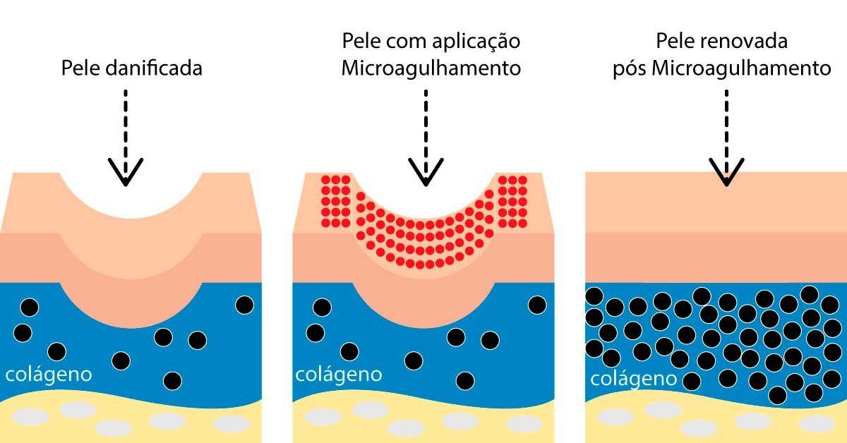 Microneedling | IBR Clinic | Odontologia Estética & Harmonização Facial ...