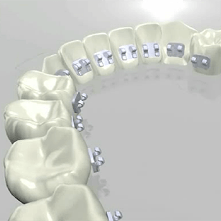 Sarah Burns Orthodontics - Lingual braces - WIN®, Incognito™, Harmony®, Forestadent® 2D