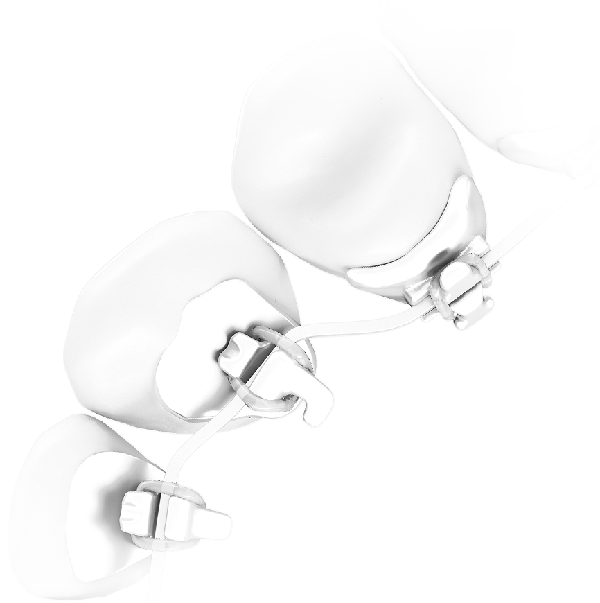 Sarah Burns Orthodontics - Lingual braces - WIN®, Incognito™, Harmony ...