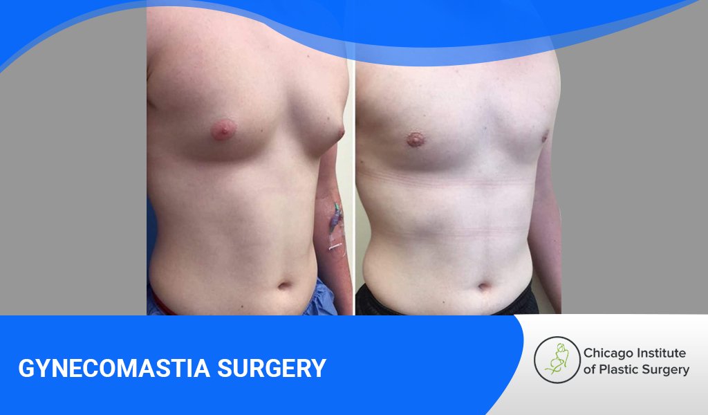 Male Gynecomastia Ultrasound
