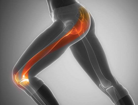 Iliotibial Band Syndrome (ITBS)