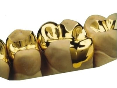 Full Alloy Restorations | Hershberger Dental Lab
