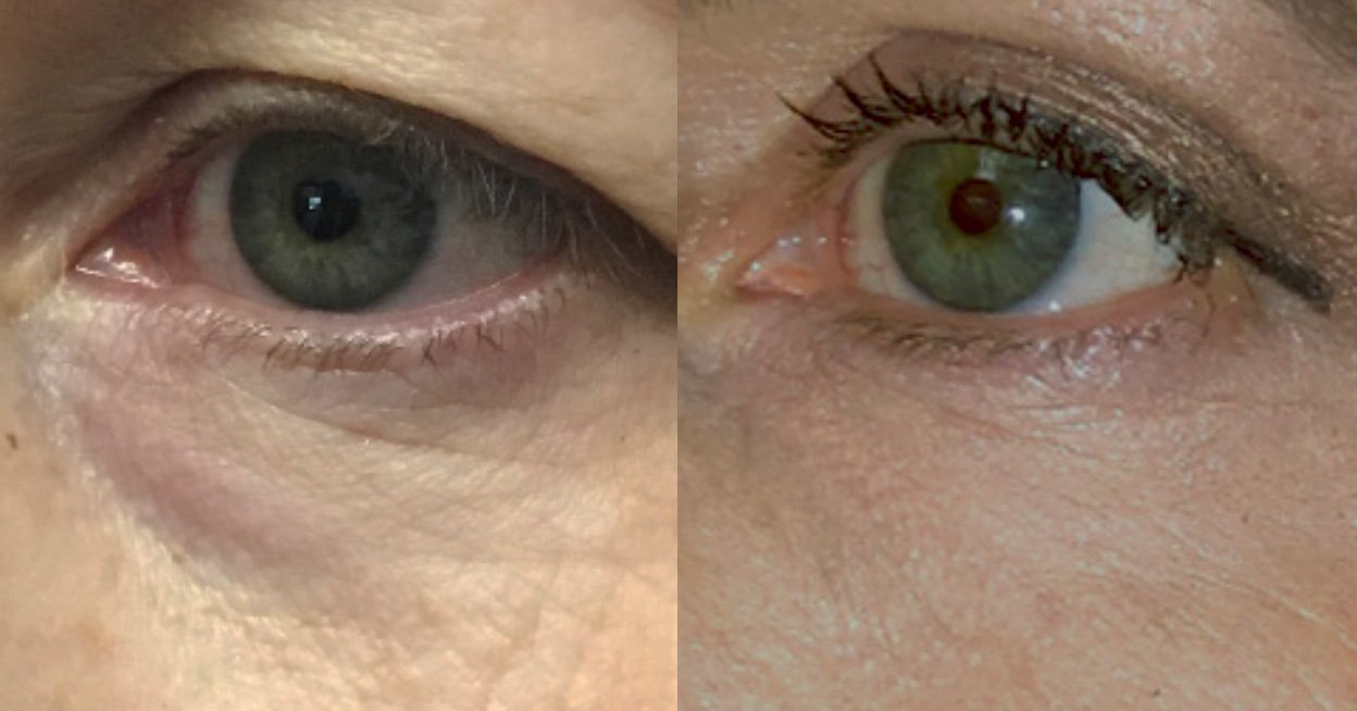 AccuTite - Minimally Invasive Precision Body, Face, & Skin Contouring