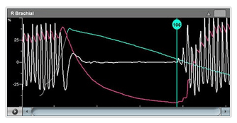Viasonix Falcon Pro | Peripheral Vascular Diagnostic System | IMI USA
